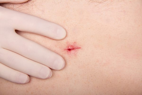 How to Care for Your Gastric Sleeve Incisions - Tuck and Sleeve